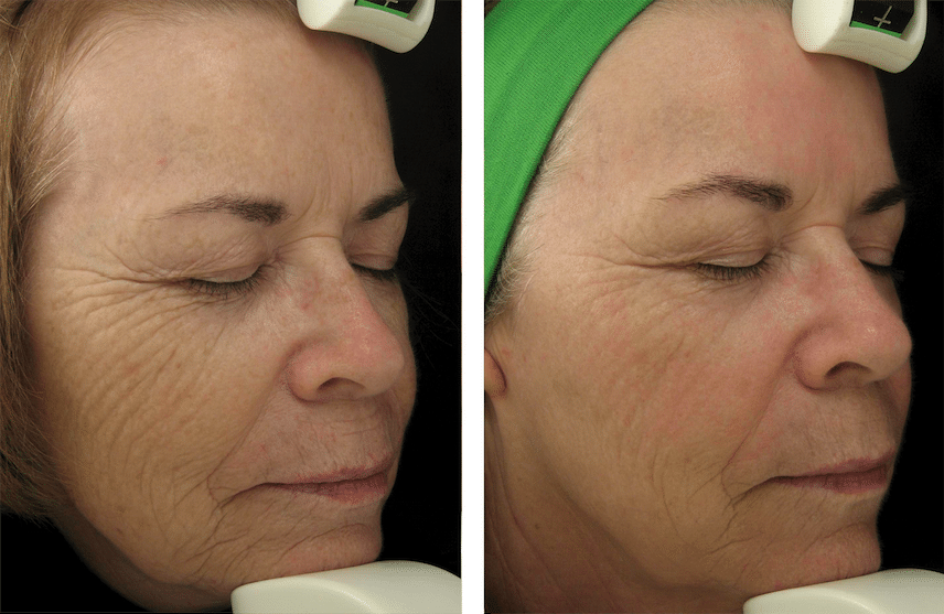 FRAXEL® DUAL Before & After | Aura Skin Spa | San Francisco CA